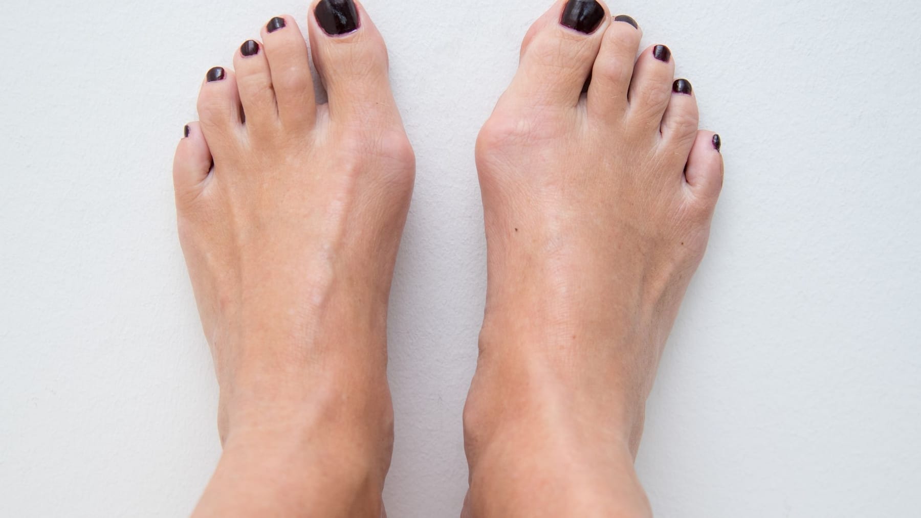 Was tun, wenn der große Zeh in Schieflage gerät?